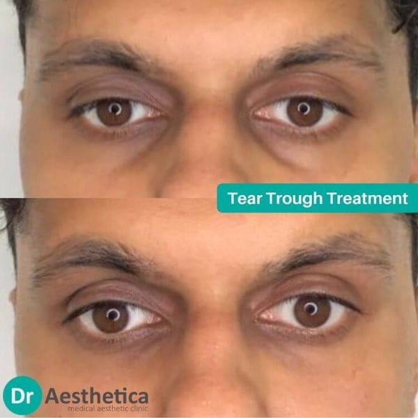 Under Eye Filler Gone Wrong - Botched Tear Trough Filler