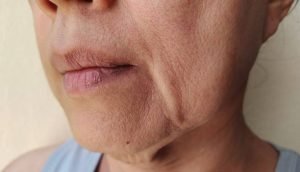 Say Goodbye to Ageing Chin with These Effective Solutions - Dr Aesthetica