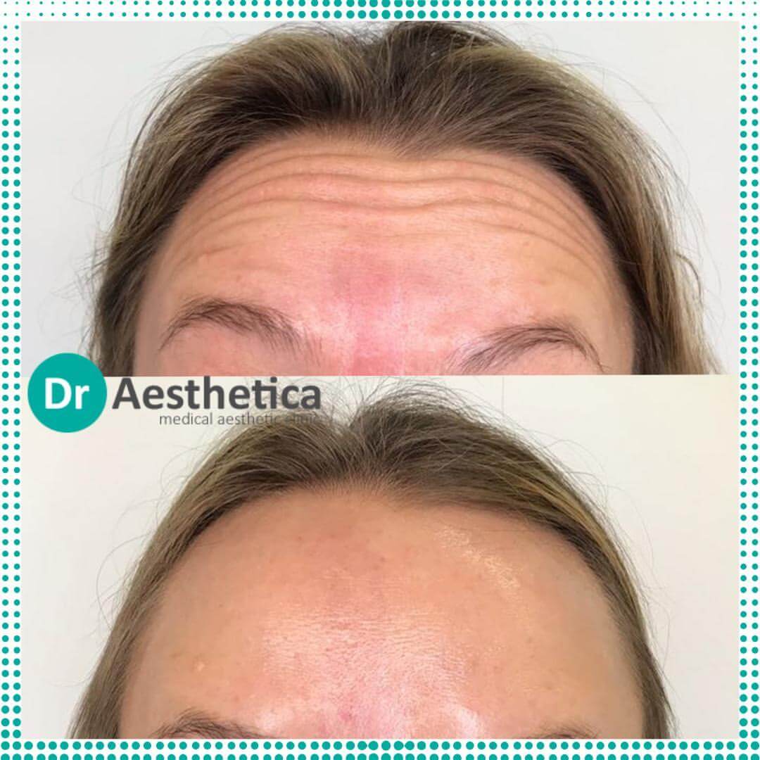 Frownie Patches vs Botox: Which One Is Right For You?